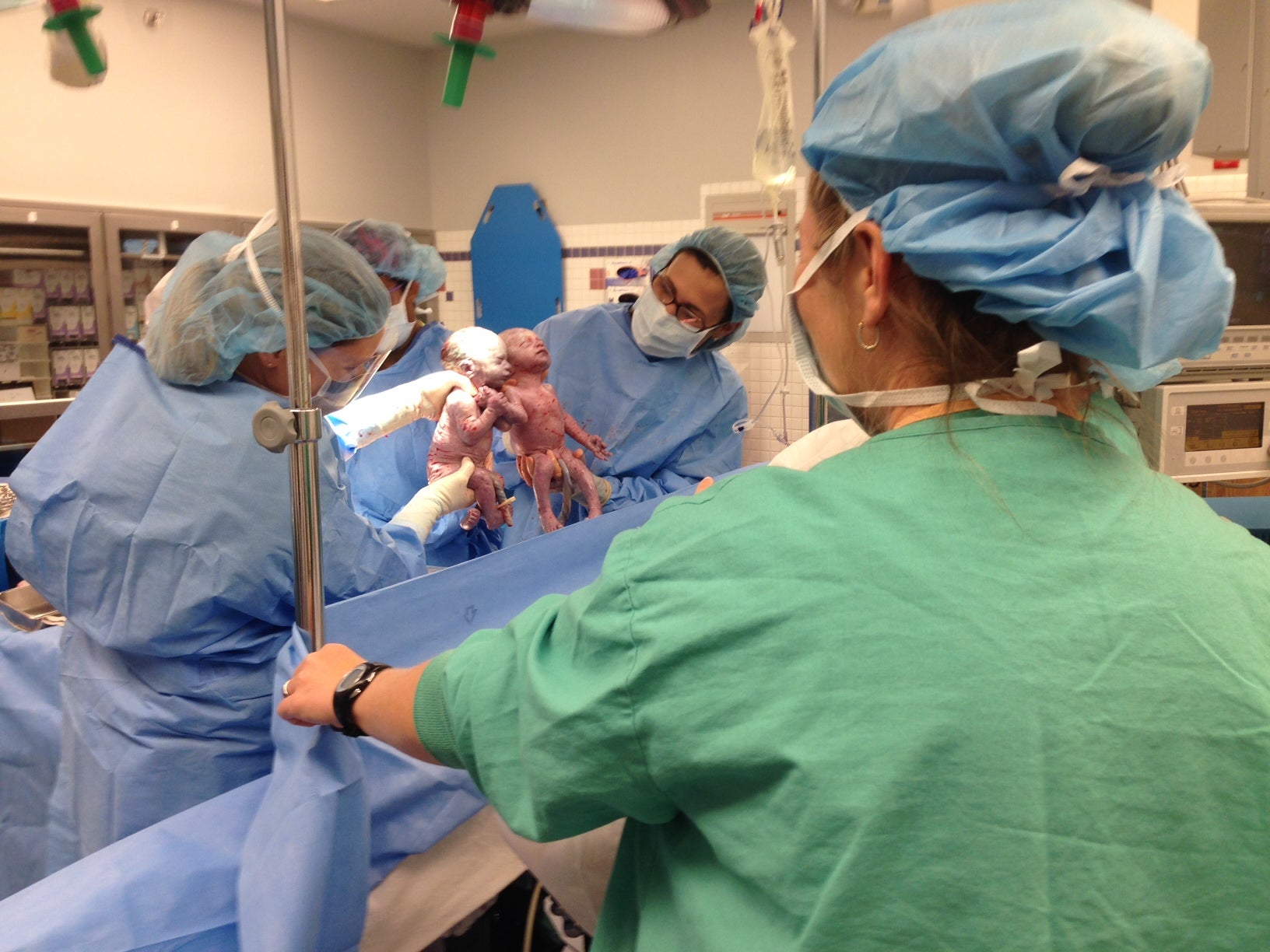 Photo: Rare Twins Hold Hands Moments After Birth