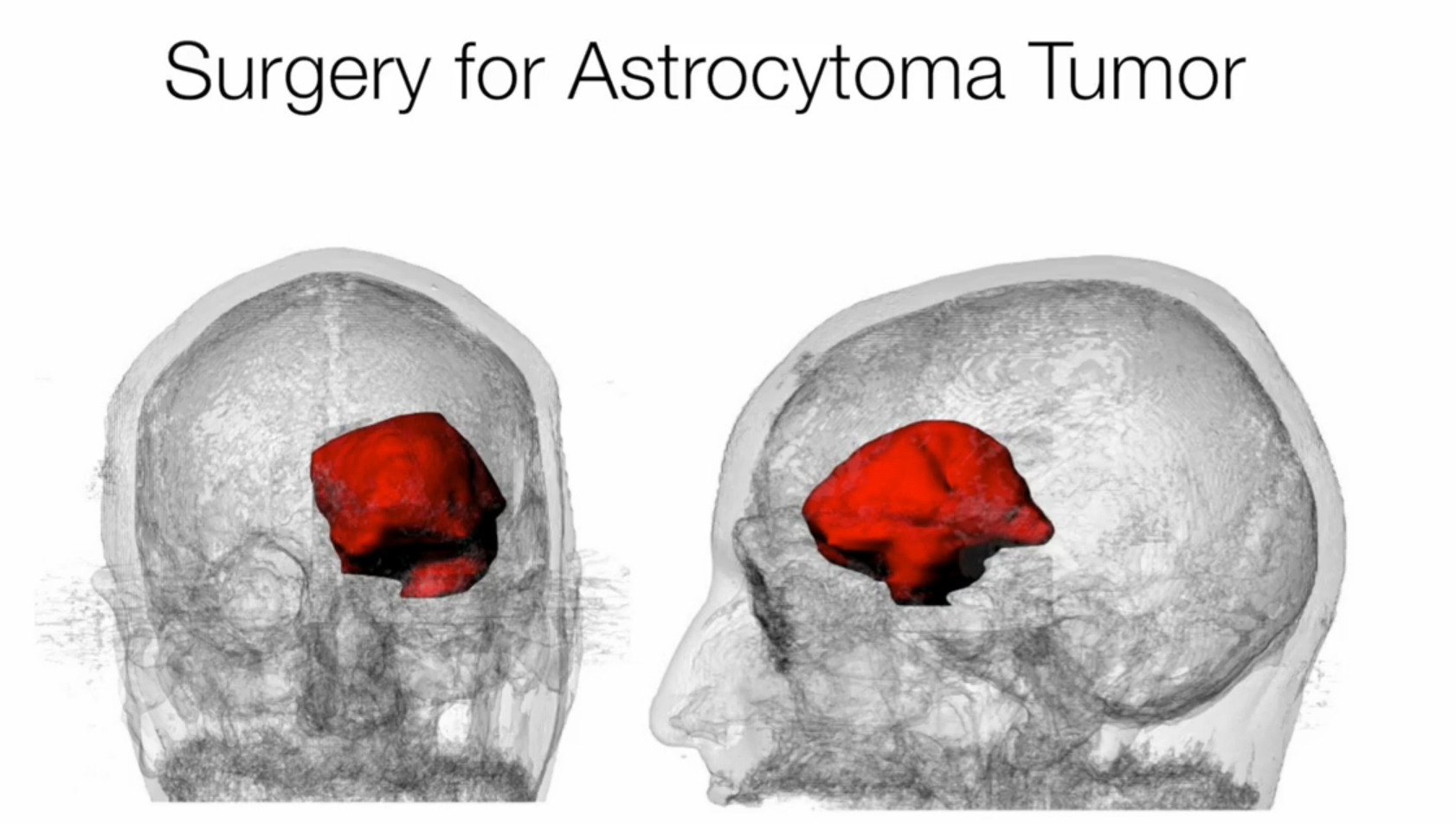 MIT Student Filmed His Own Brain Surgery