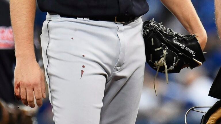 Indians' Trevor Bauer leaves in first inning after blood drips from finger