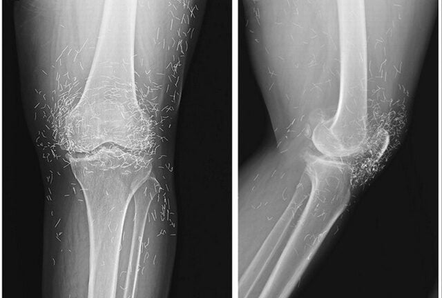X-ray of acupuncture captures striking image