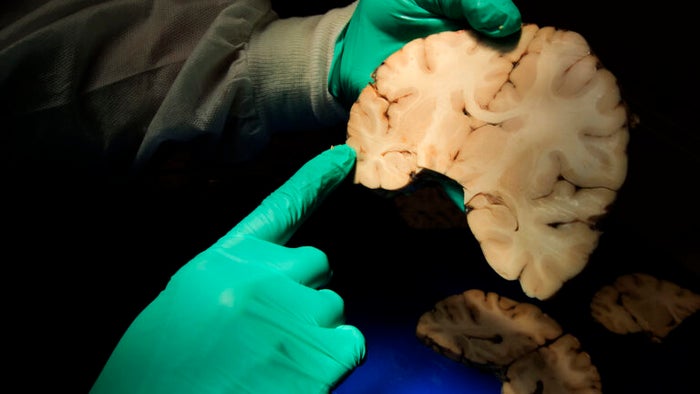 BU researchers find CTE in almost 92% of former NFL players they studied